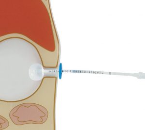 Stoma Measuring Device - TECHNOPATH